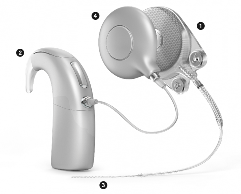 Cochlear Implant 101 - because sound matters